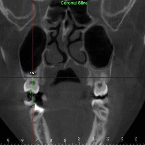 Veau Classification Download Table