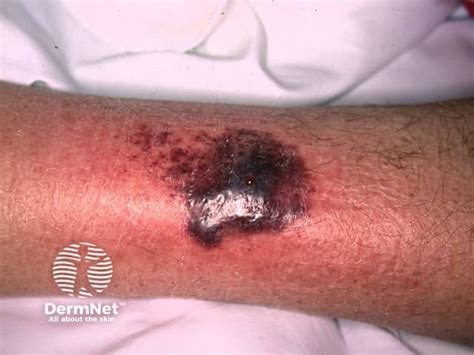 Pyoderma Gangrenosum Image