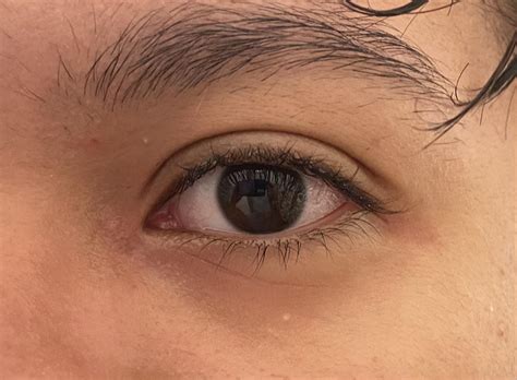 Why Does My Scalp Started To Itch After Using Shikakai And Reetha R Nopoo