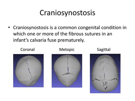 Ppt Classification And Feature Selection For Craniosynostosis Powerpoint Presentation Id 2014169