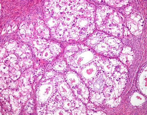 Clear Cell Carcinoma Of Ovary Light Micrograph Stock Image C061