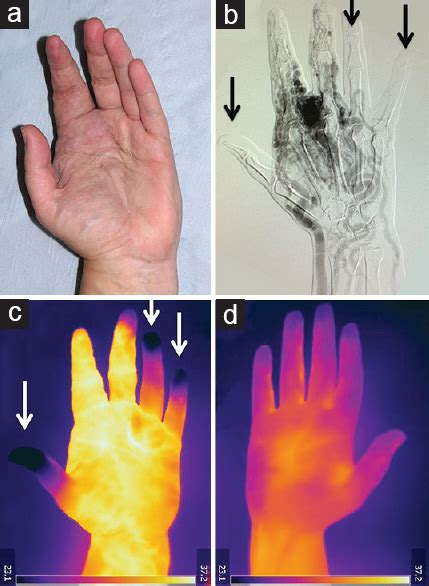 Thermographic Assessment Of A Vascular Malformation Of The Hand A New
