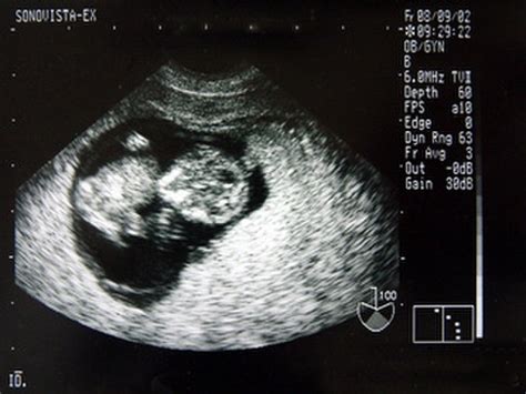 Échographie Définition Et Explications