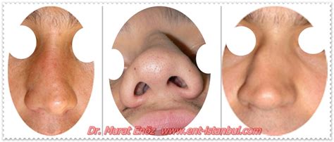 Nasal Fracture Splint