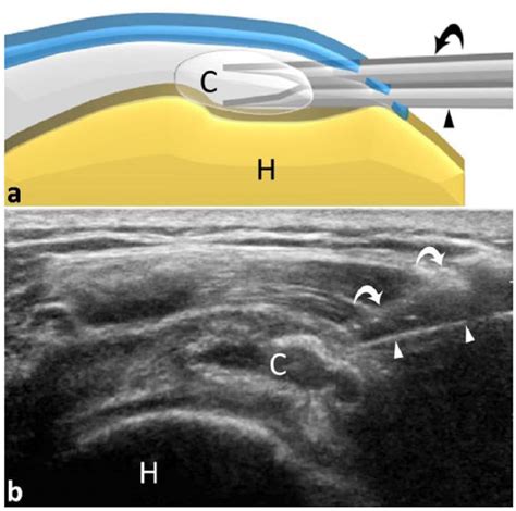 Ultrasound Guided Percutaneous Treatment For Calcific Tendinitis Of The