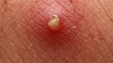 How To Get Rid Of A Boil On Bum Cheek Youtube