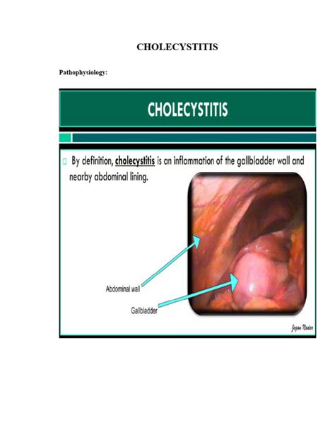 Cholecystitis Pdf