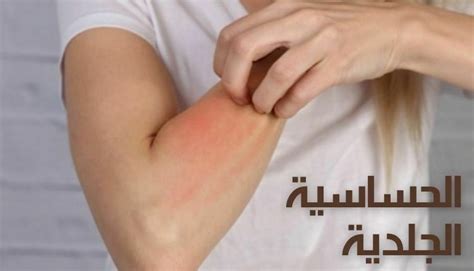 الحساسية الجلدية؛ أهم 4 أنواع للحساسية، وطريقة علاجها