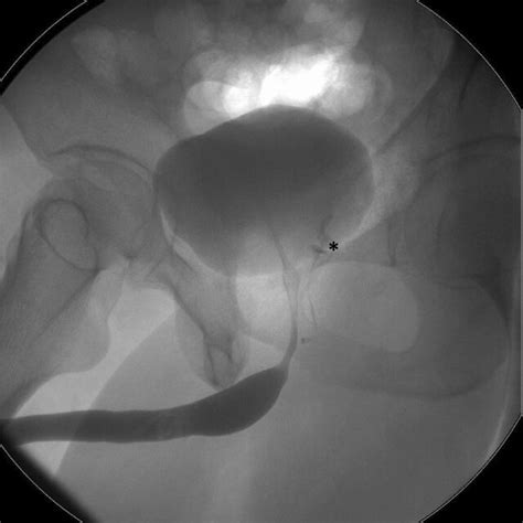 Retrograde Urethrogram Shows Opacification Of The Urethra And Bladder
