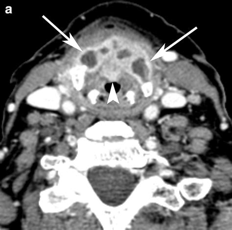 Pre Operative Contrast Enhanced Ct Of The Neck A Axial And B