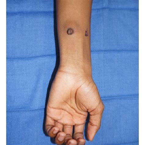 Low Power Pathology Slide Features Of Accessory Nipple Including