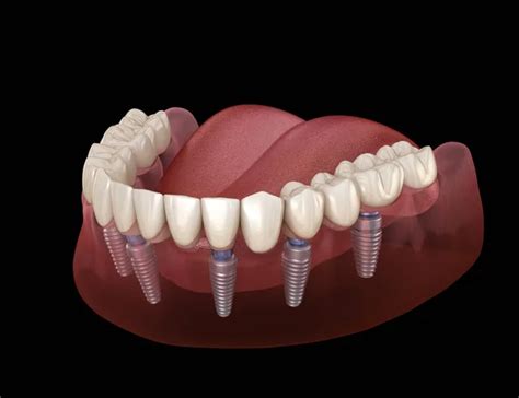 Mandibular Prosthesis All System Supported Implants Medically Accurate Illustration Human Stock