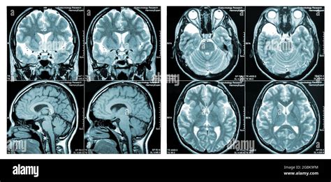 MRI Scan Image Of A Human Brain Showing All Main Multiple Sclerosis