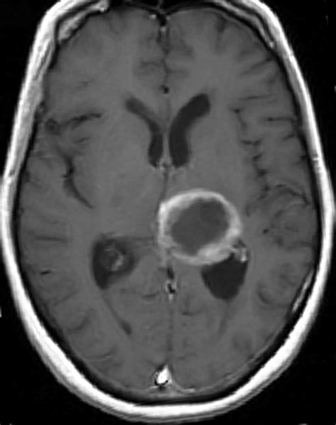 Distinction Between Cerebral Abscesses And High Grade Neoplasms By