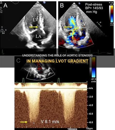 Understanding The Role Of Aortic Stenosis In Managing Lvot Gradient