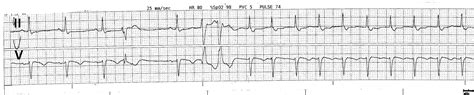 ECG Rhythms Junctional Tachycardia True Or False