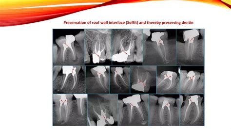 Minimal Invasive Endodontics Pptx