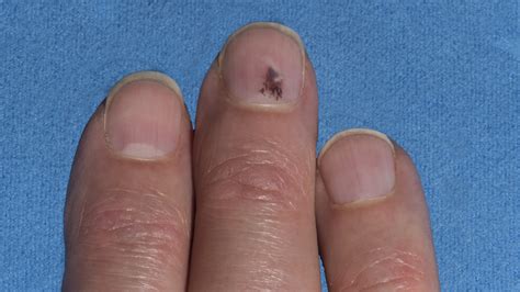 Melanoma Pictures Early Stages 2 Symptoms And Pictures