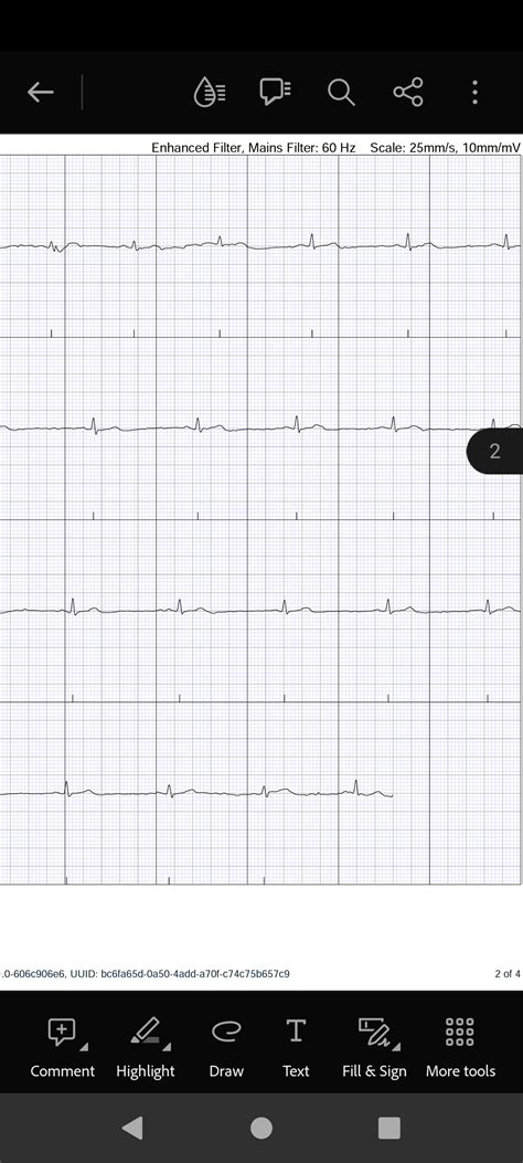 Qt Interval Long R Ekg