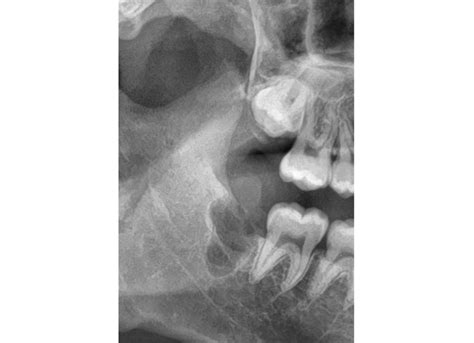 【30代男性】親知らずで歯茎が腫れる 池袋駅の歯医者なら池袋駅東口つのり歯科