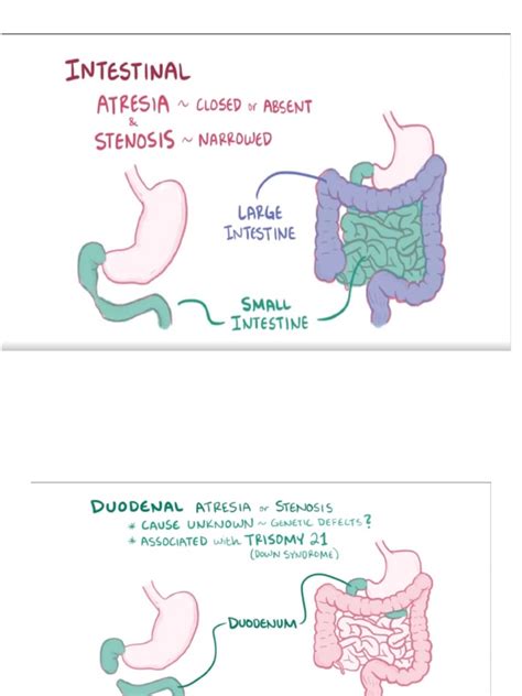 Atresia Intestine Pdf