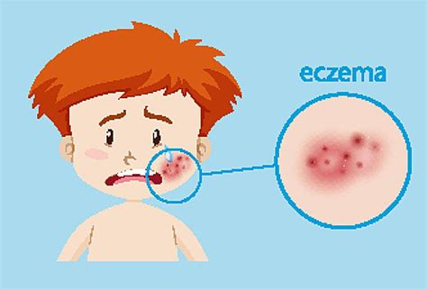 Sick Boy With Eczema Poster Youth Microbiology Vector Poster Youth