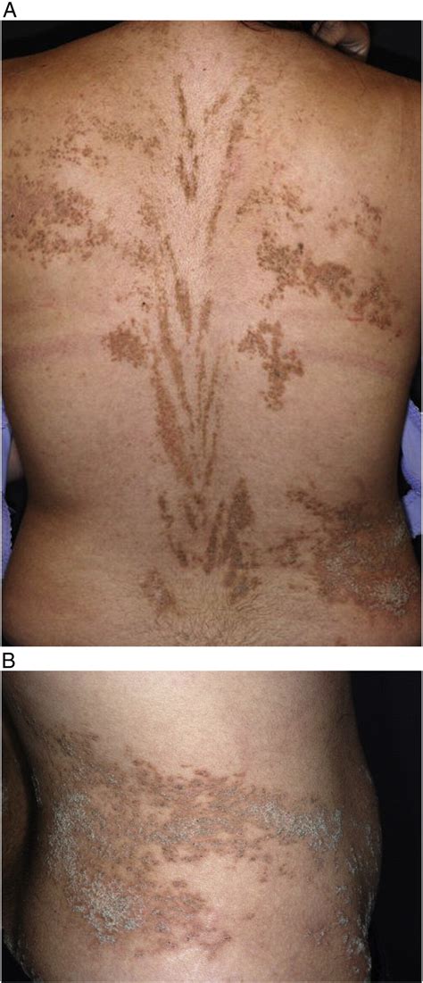 Patterned Disorders In Dermatology Clinics In Dermatology