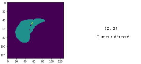 GitHub Najoua Zeffate Cancer Liver Detection This Project Aims To