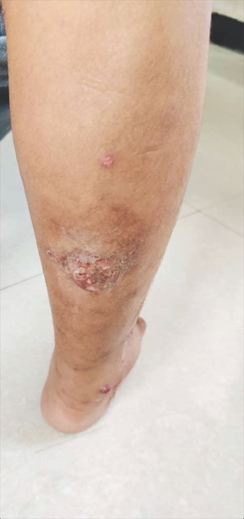 Tuberculids A Narrative Review Pmc