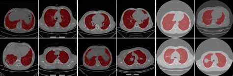 Segmentation Of Lung Parenchyma Using Small Patches Download Scientific Diagram