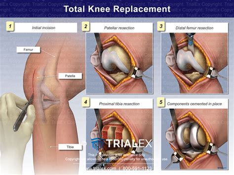 Knee Replacement Medical Id Card At Boyd Ferguson Blog