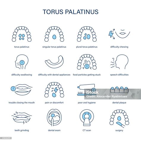 Torus Palatinus Symptoms Diagnostic And Treatment Vector Icon Set Stock Illustration Download
