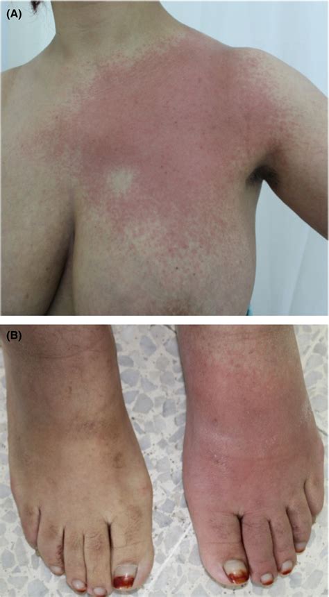 A Maculopapular Confluent Erythema Involving The Left Axilla Download Scientific Diagram
