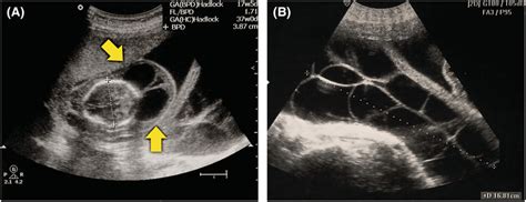Transabdominal Ultrasound Examination A Axial View Of The Fetus