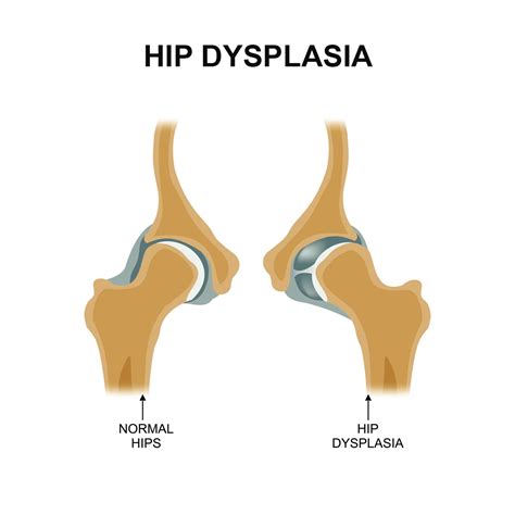 Hip Dysplasia Symptoms And Treatment Aurora Health Care