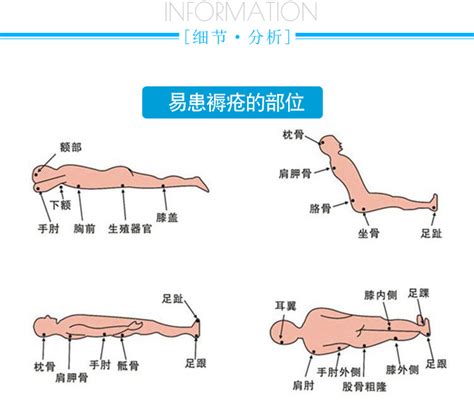 气垫单人充气床褥疮护理床垫老年卧床病人防压疮翻身家用自动 阿里巴巴