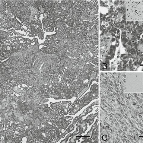 At Exploration The Cyst Was Seen To Have Protruded Into The Right