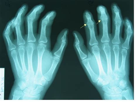 Scleroderma Hands Xray
