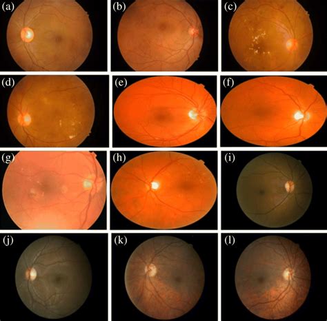 Sample Training Set Images Ab Sample Idrid Dataset Normal Images Cd Download Scientific