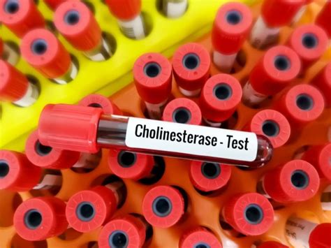 ما نسبة تحليل Ldl الطبيعي؟