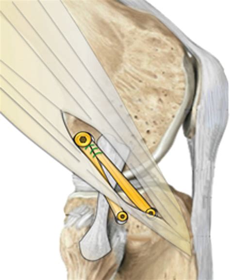 Anterolateral Myocardial Infarction Semantic Scholar