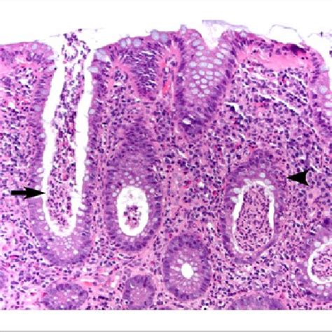 Localized Pseudopolyps Were Found And Biopsied In The Sigmoid And Download Scientific Diagram