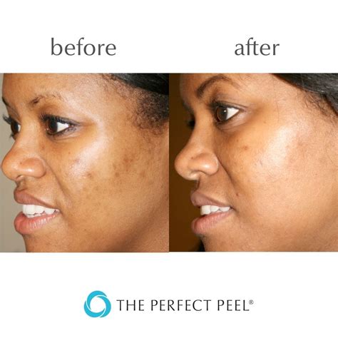 The Perfect Peel® Inside Aesthetics