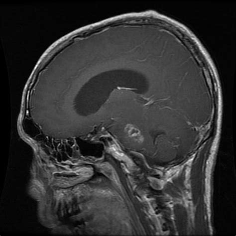 Tumor Object Detection Dataset And Pre Trained Model By Ysa