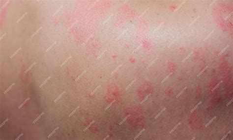 Premium Photo Close Up Allergy Rash Around Back View Of Human With Dermatitis Problem Of Rash