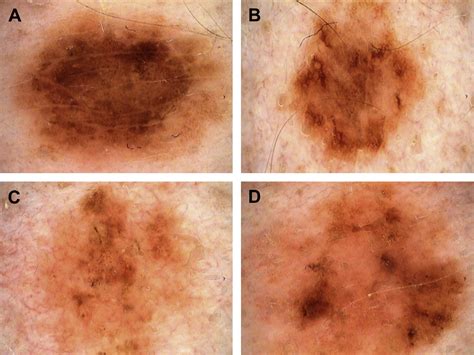 Dysplastic Nevus Dermatologic Clinics