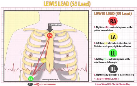 ECG Educator Blog Atrial Flutter