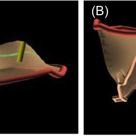 Examples Of 3d Mitral Annulus Analysis With Echo‐pac Software A 3d
