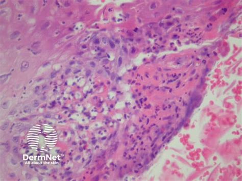 Blastomycosis Like Pyoderma Pathology Image