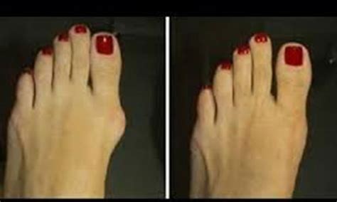 Bone Spurs On Big Toe Of Foot Store